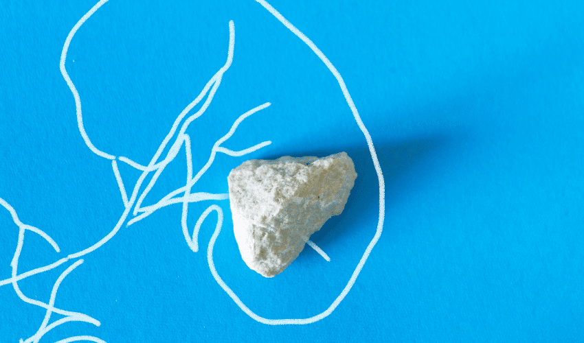 15 Things That Cause Kidney Stones: Uncover the Hidden Triggers - Page ...