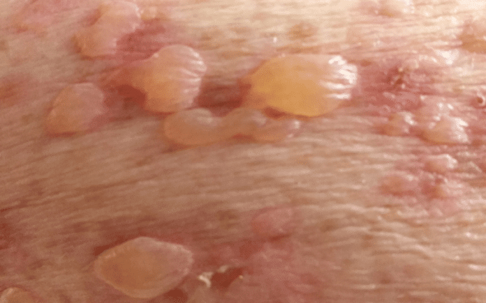 Stevens-Johnson Syndrome: A Closer Look at SJS and its 13 Key Symptoms ...