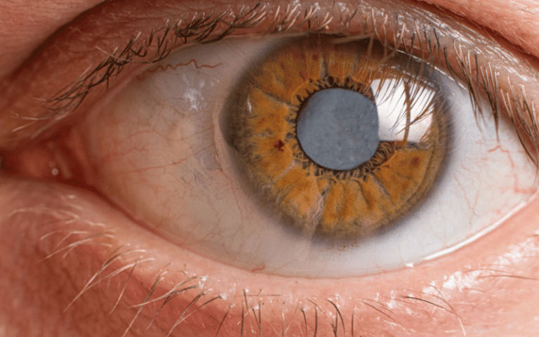 20 Common Eye Conditions and Diseases: Spot the Signs and Symptoms ...