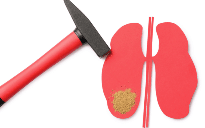 10 Types of Kidney Stones: All You Need to Know - Page 10 of 11