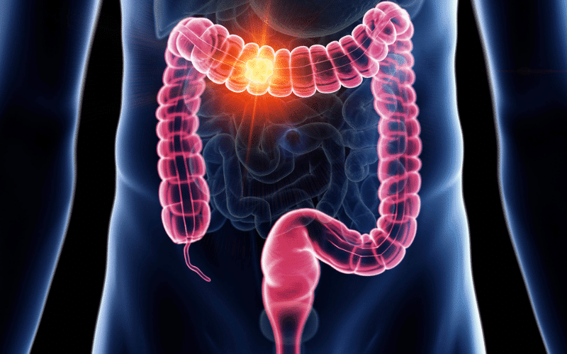Ischemic Colitis: Decoding the 10 Telltale Symptoms and Understanding ...
