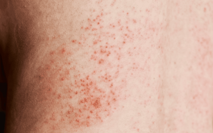 Top 10 First Signs of Syphilis: Early Detection Matters - Page 3 of 11