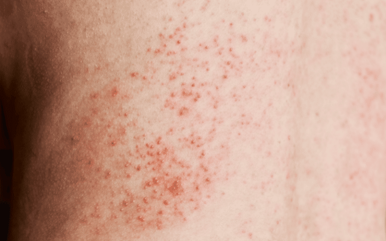 Top 10 First Signs of Syphilis: Early Detection Matters - Page 3 of 11