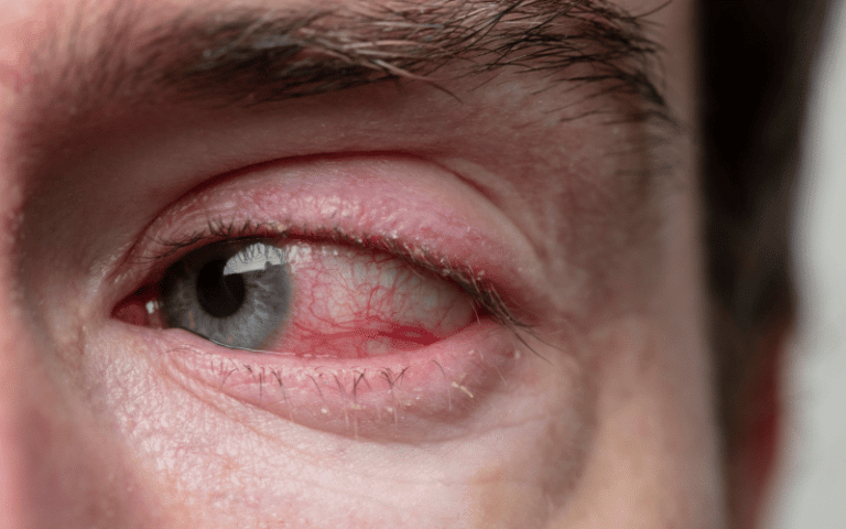 15 Symptoms of Pink Eye (Conjunctivitis) You Shouldn't Ignore