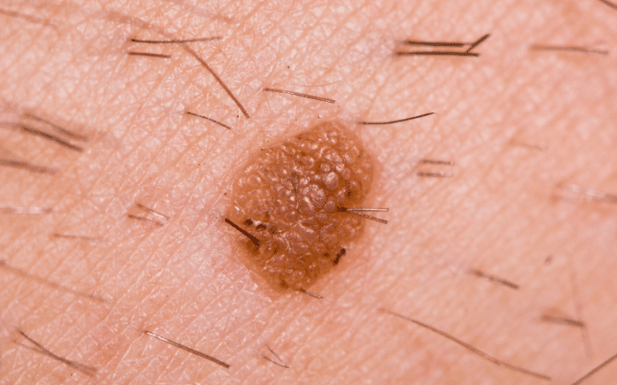 15 Syphilis Symptoms: How to Identify and Address this Silent Intruder ...