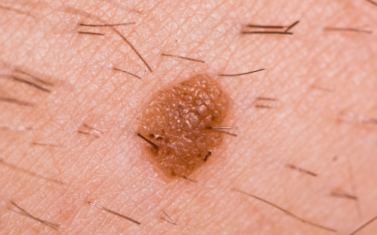 15 Syphilis Symptoms: How to Identify and Address this Silent Intruder ...