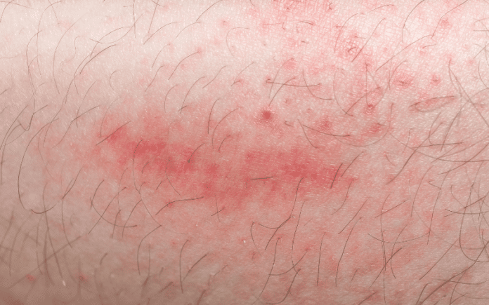 Toxic Epidermal Necrolysis: Top 10 Alarming Symptoms to Watch Out For ...