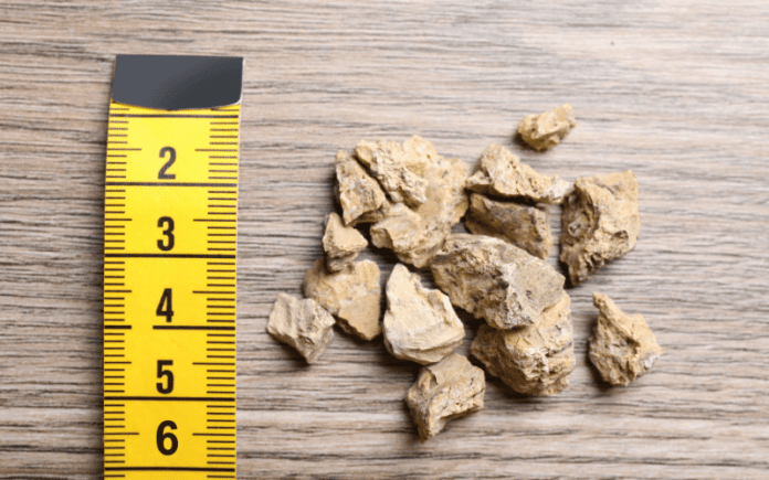 10 Types of Kidney Stones: All You Need to Know - Page 7 of 11