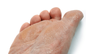 Understanding Neurodermatitis: An In-depth Look into Its Top 10 ...