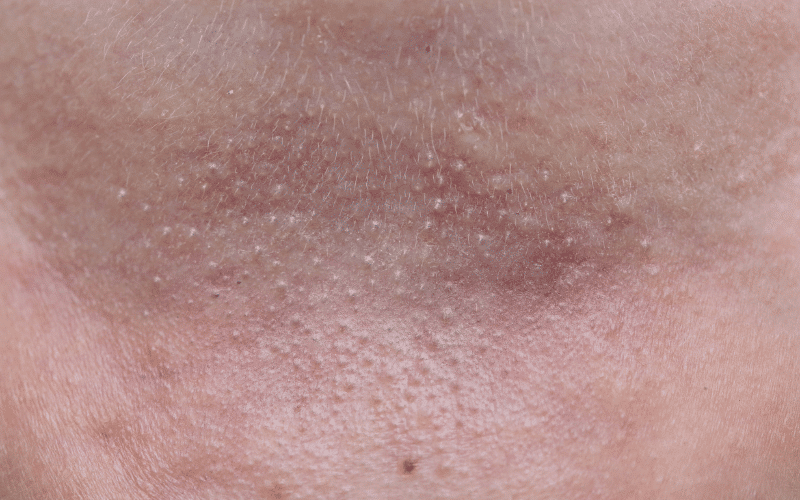 Scratching the Surface: Top 10 Causes of Itchy Skin Rashes - Page 6 of 11