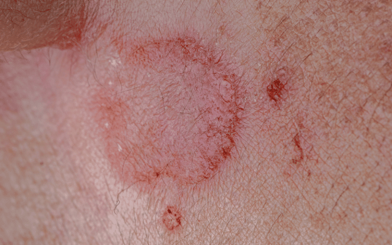 Discoid Lupus Erythematosus: Understanding the Symptoms and Beyond