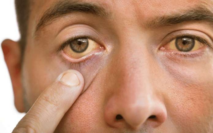 Top 10 Early Symptoms and First Signs of Liver Failure: Know the ...