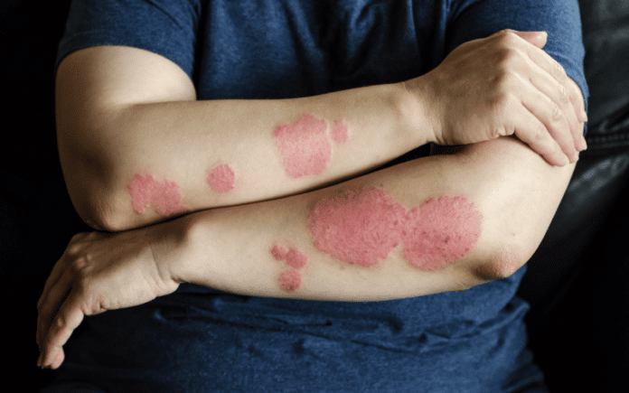 Nummular Eczema: Understanding the 10 Most Common Symptoms