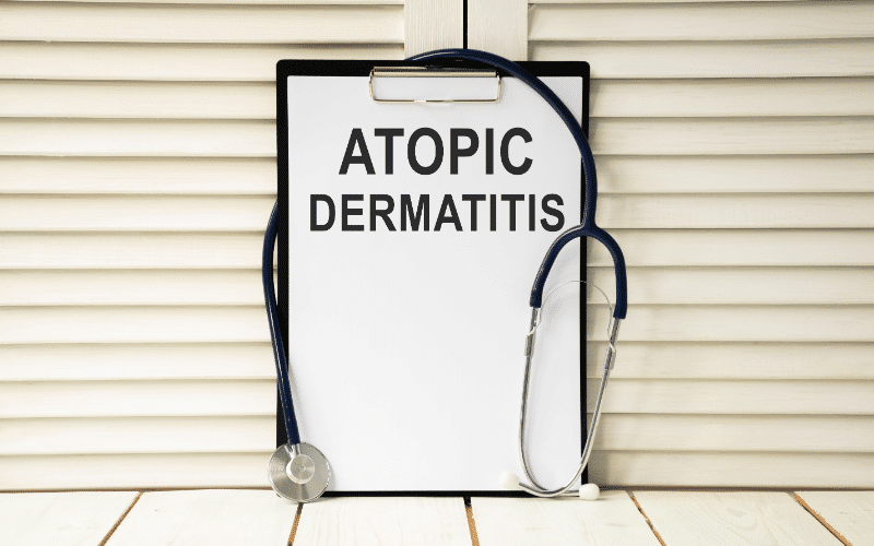 Severe Atopic Dermatitis: 10 Symptoms You Should Know