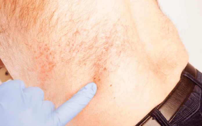 15 Common Skin Diseases: Symptoms, Causes, and Treatments - Page 8 of 16