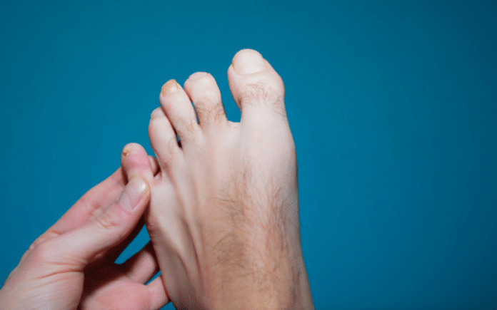 Ringworm (Tinea Corporis): 13 Symptoms You Need to Know About in Humans ...