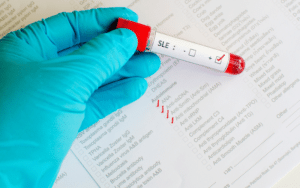 Unmasking Lupus: An In-depth Look at Its Five Forms