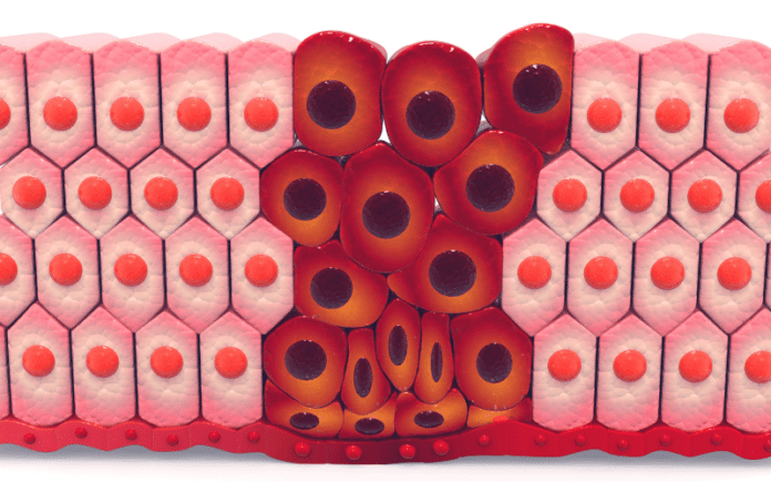 Unwanted Comeback: 5 Signs That Thyroid Cancer Has Returned