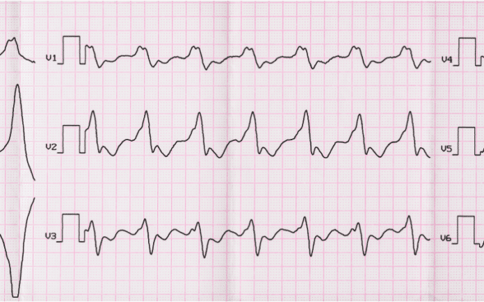 Identifying the Early Warning Signs: 10 Symptoms of Atrial Fibrillation ...