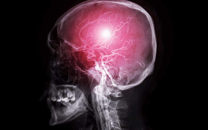 Understanding the Prognosis for Cerebral Amyloid Angiopathy: A Detailed ...