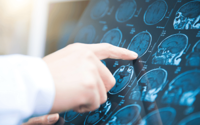 Enlightening Insights into Life Expectancy with Multiple System Atrophy ...