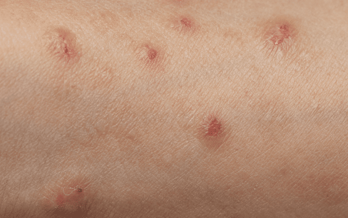 Behcet's Disease Uncovered: A Deeper Look at the Top 10 Symptoms - Page ...