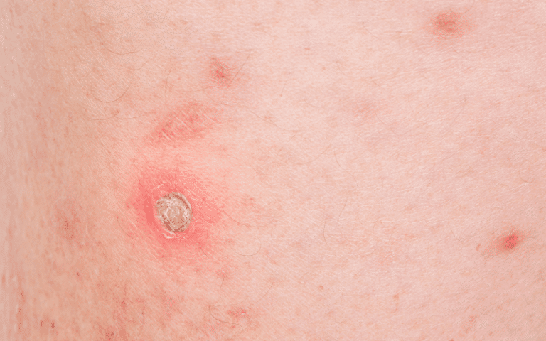 Understanding Behcet's Disease: A Deep Dive into its Top 10 Symptoms ...