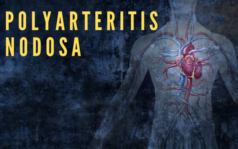 Know Your PAN: Deciphering the Top 10 Symptoms of Polyarteritis Nodosa