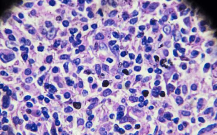 The Top 15 Must-Know Facts About Cutaneous T-Cell Lymphoma (CTCL)