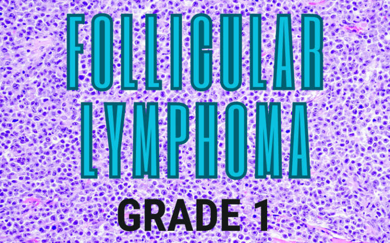 Demystifying Follicular Lymphoma: From Grade 1 to 3