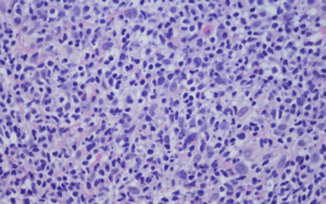 10 Common Symptoms of Marginal Zone B-Cell Lymphoma (MZL)