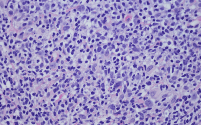 10 Common Symptoms of Marginal Zone B-Cell Lymphoma (MZL)