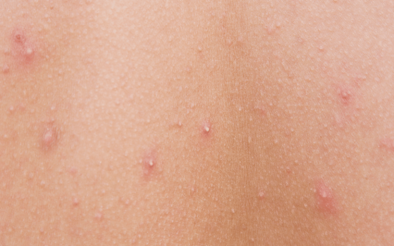 What's Your Skin Telling You? Identifying Pityriasis Lichenoides ...