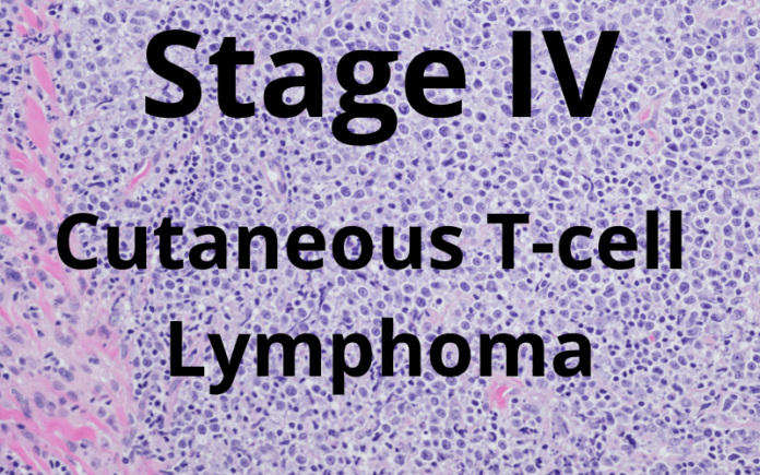 Understanding the Four Stages of Cutaneous T-cell Lymphoma (CTCL ...