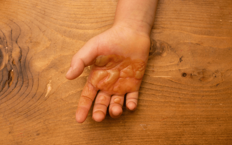 The Top 10 Revealing Symptoms of Stevens-Johnson Syndrome (SJS) - Page ...