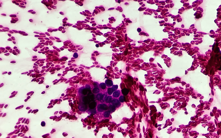 Demystifying Hepatocellular Carcinoma (HCC) Prognosis: 10 Vital Facts ...