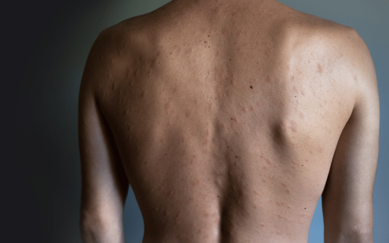 The Top 10 Revealing Symptoms of Stevens-Johnson Syndrome (SJS) - Page ...