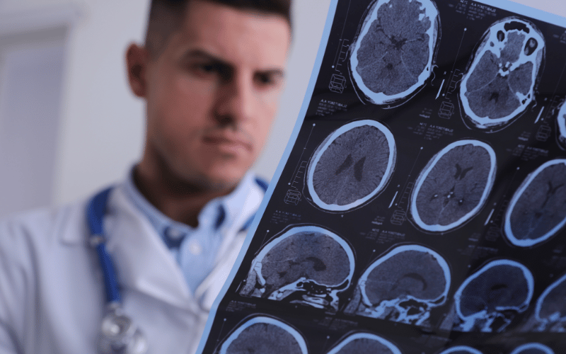 The Four Types of Multiple Sclerosis: A Detailed Exploration