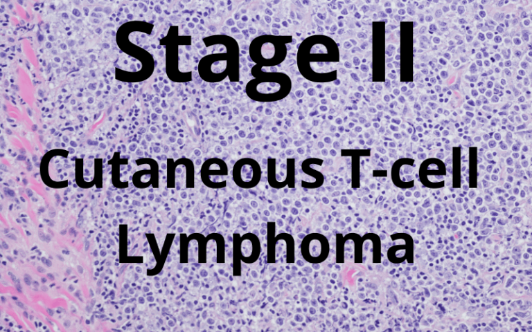 Understanding the Four Stages of Cutaneous T-cell Lymphoma (CTCL) - Page 2 of 5