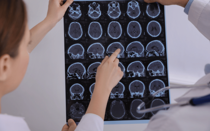 Understanding Secondary Progressive Multiple Sclerosis: 10 Common Symptoms