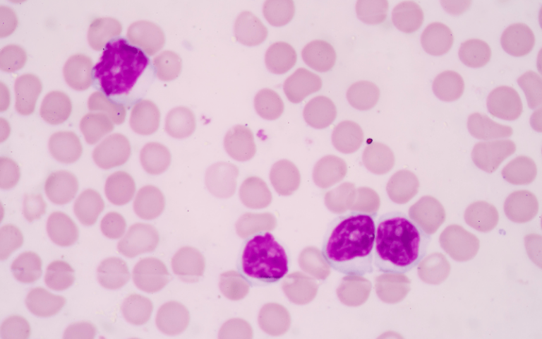 15 Important Facts About Chronic Lymphocytic Leukemia (CLL, B-cell ...