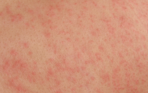 Recognize Perioral Dermatitis: The 10 Symptoms Unmasked