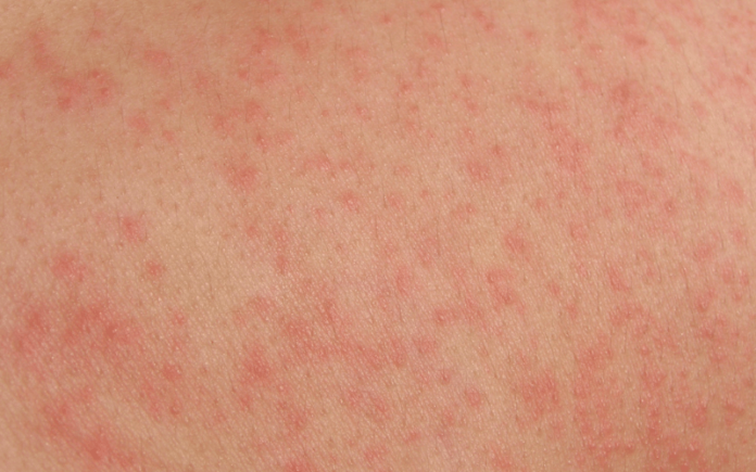 Recognize Perioral Dermatitis The 10 Symptoms Unmasked