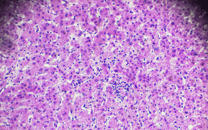 10 Symptoms of Fibrolamellar Hepatocellular Carcinoma (FHCC ...