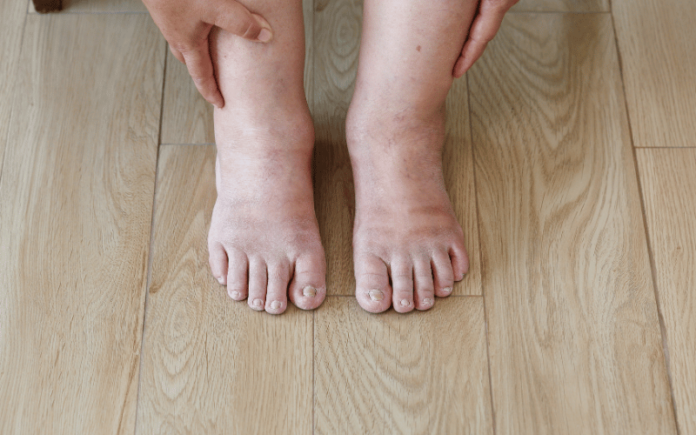 The Top 10 Symptoms of Angioedema (Quincke's Edema) Every Individual ...