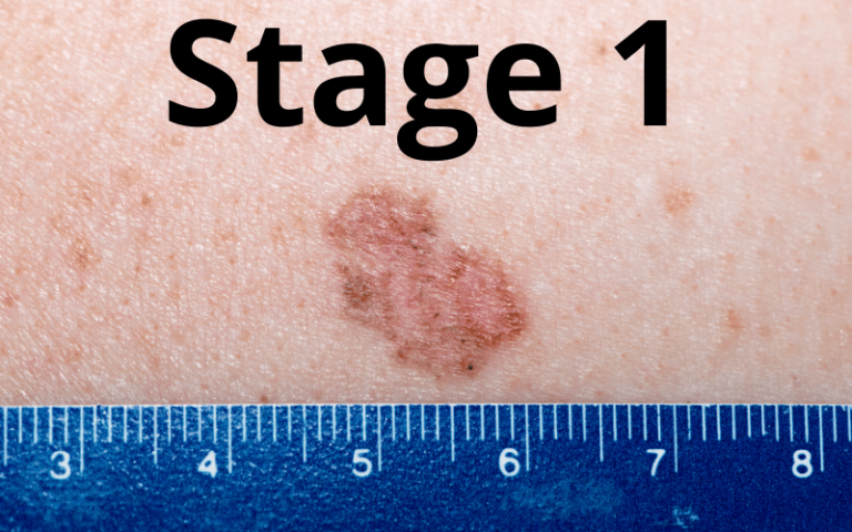 Unveiling the 5 Stages of Basal-Cell Carcinoma