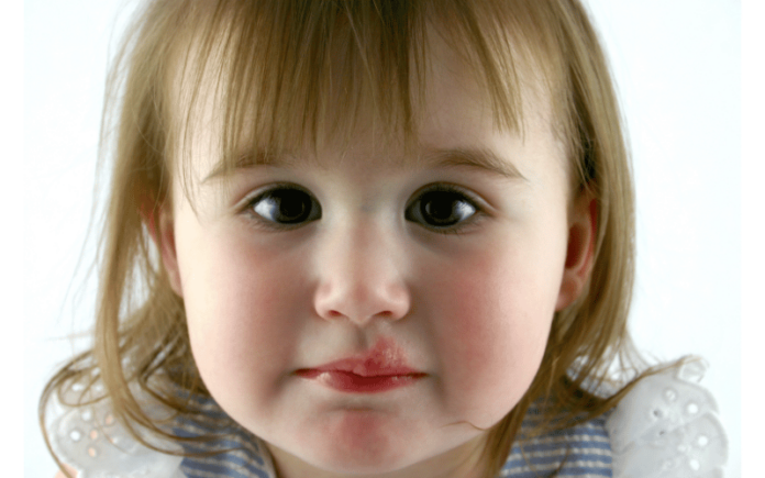 Cold Sore Symptoms in Kids: What Every Parent Should Know
