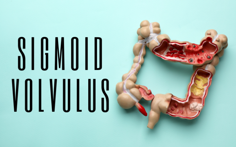 Heed the Warning: Top 10 Symptoms of Sigmoid Volvulus