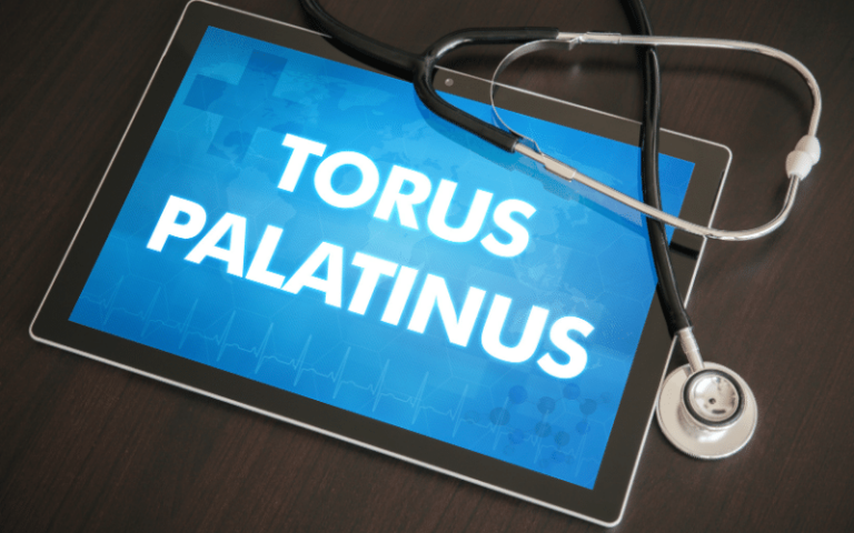 Top 10 Symptoms of Torus Palatinus: Demystifying the Dental Phenomenon