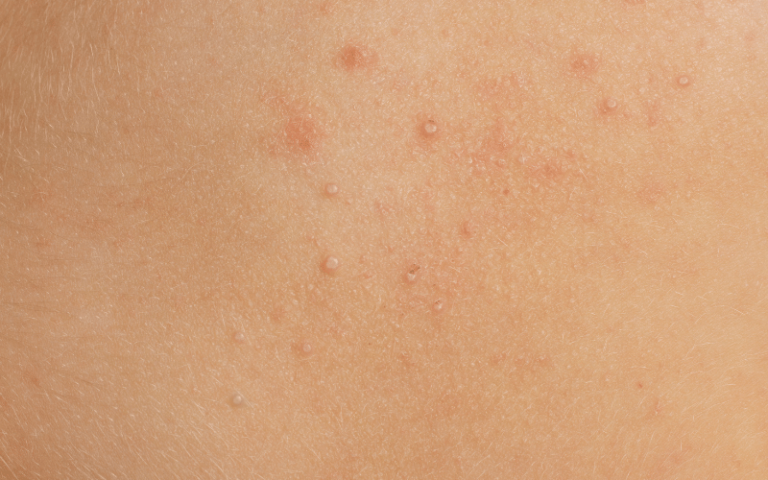 Skin Stories: Molluscum Contagiosum and its 10 Telltale Signs